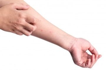 Timbul Kemerahan Pada Kulit? Berikut Cara Pengobatannya | Barisan.co